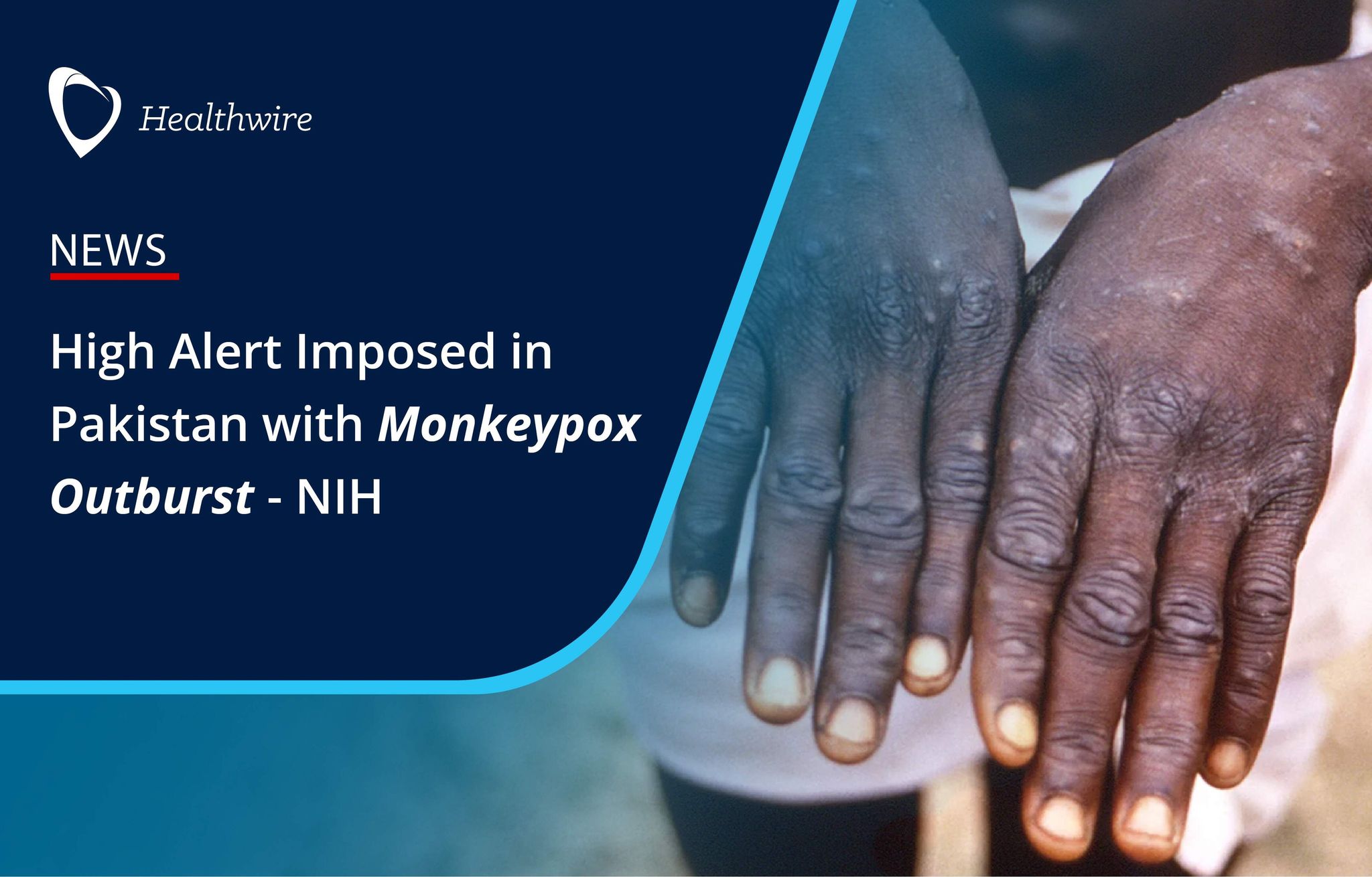 High Alert Imposed In Pakistan With Monkeypox Outburst Nih | Healthwire ...